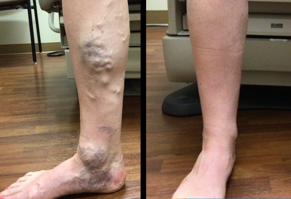 Varicose Veins Legs